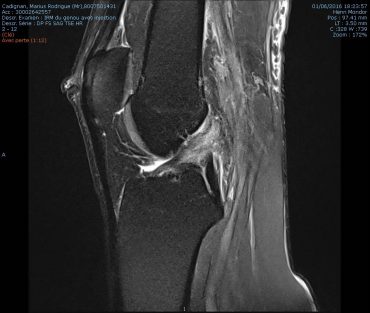Opération LCA - Rupture du ligament croisé antérieur | Ligamentoplastie