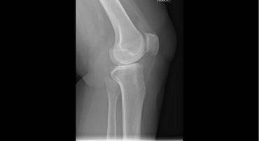 Arthrose du genou (Gonarthrose) - Traitements, opérations & prothèses