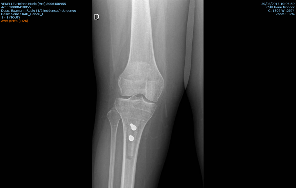 Luxation de la rotule, opération - Traitement et chirurgie