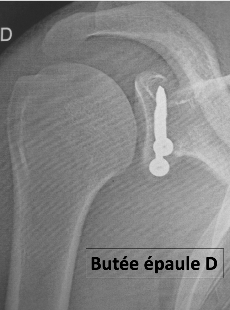 Luxation épaule et instabilité - Chirurgie du sport, opérations ...